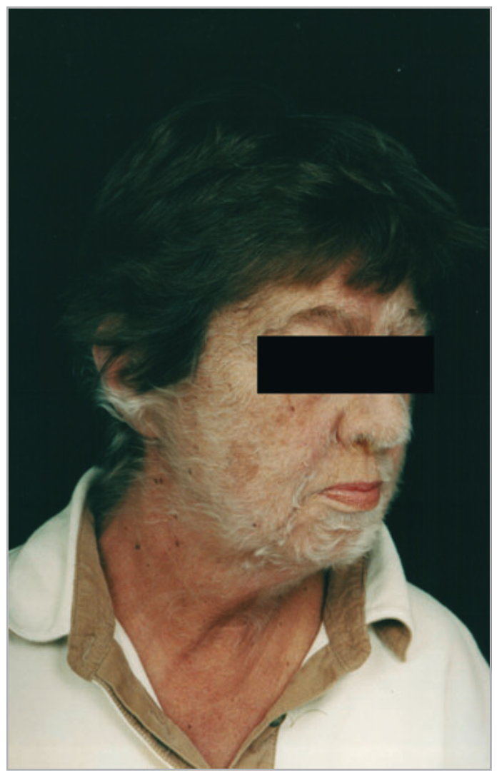 後天性毳毛性多毛症 Acquired Hypertrichosis Lanuginosa｜ある内科医のまとめ