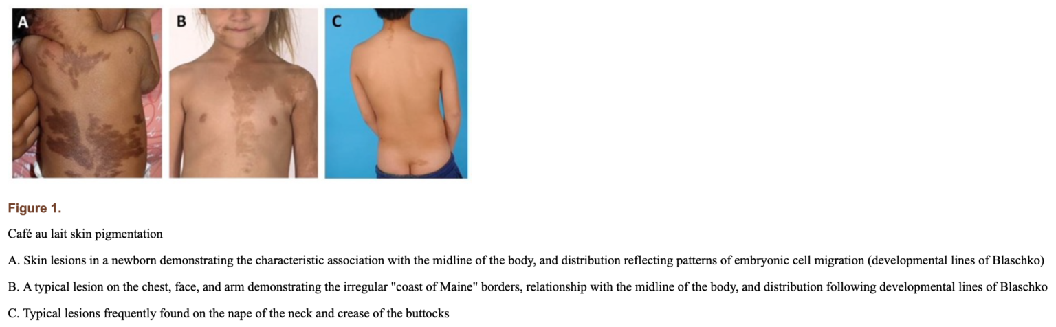 McCune- Albright Syndrome｜ある内科医のまとめ