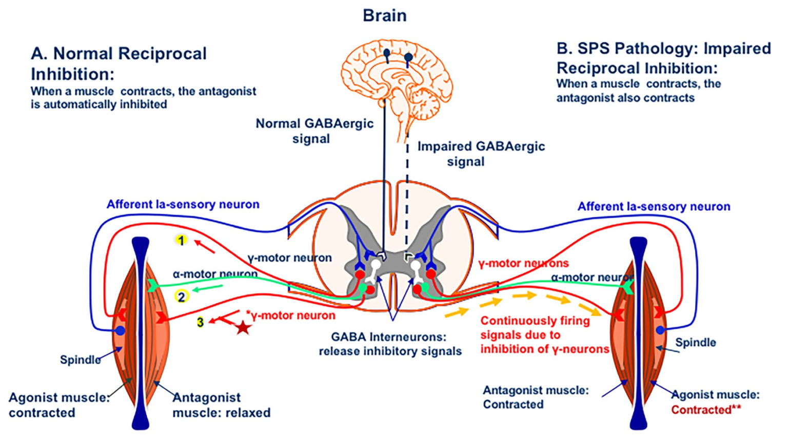 抗GAD抗体関連疾患とstiff person症候群｜ある内科医のまとめ